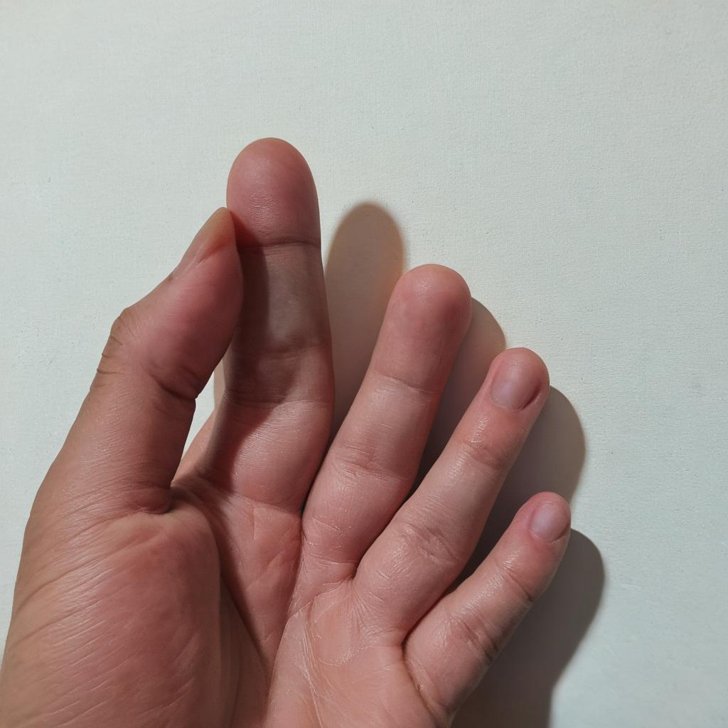 Close-Up of Swollen Middle Finger: A Clinical Observation